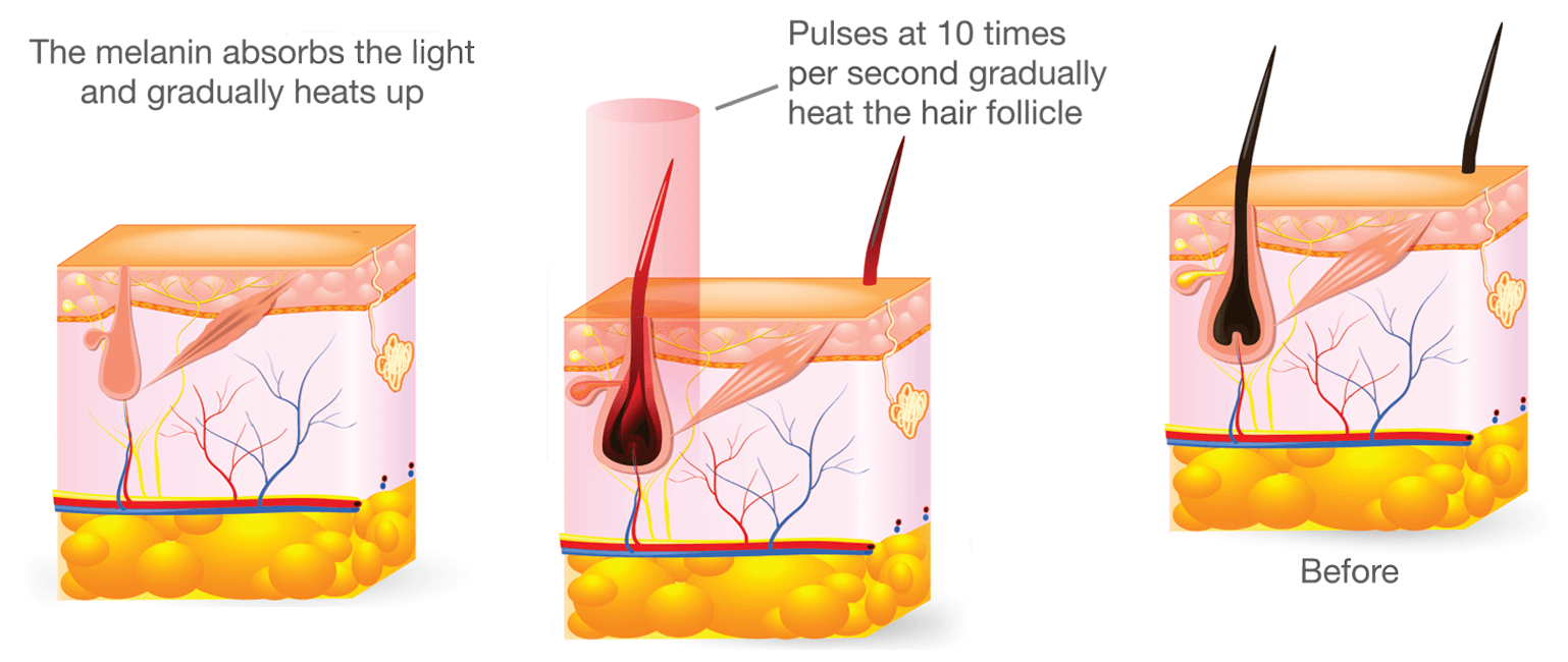 Super Hair Removal - The Aesthetic Chapter Singapore