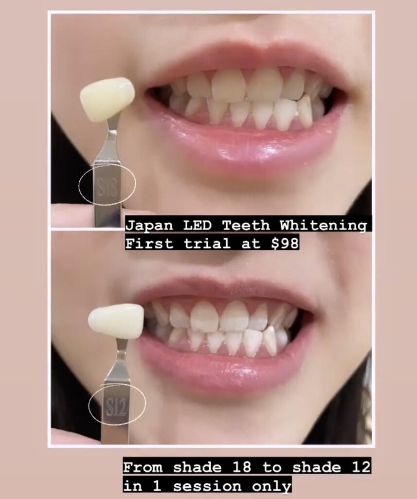 Japan Teeth Whitening (No1 Brand In Japan)