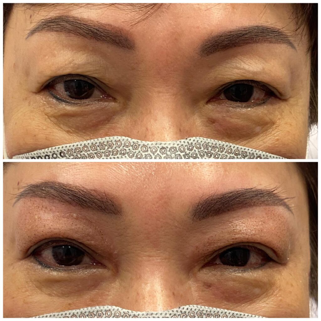 Fibroblast Non Invasive Treatment Plasma Skin Tightening