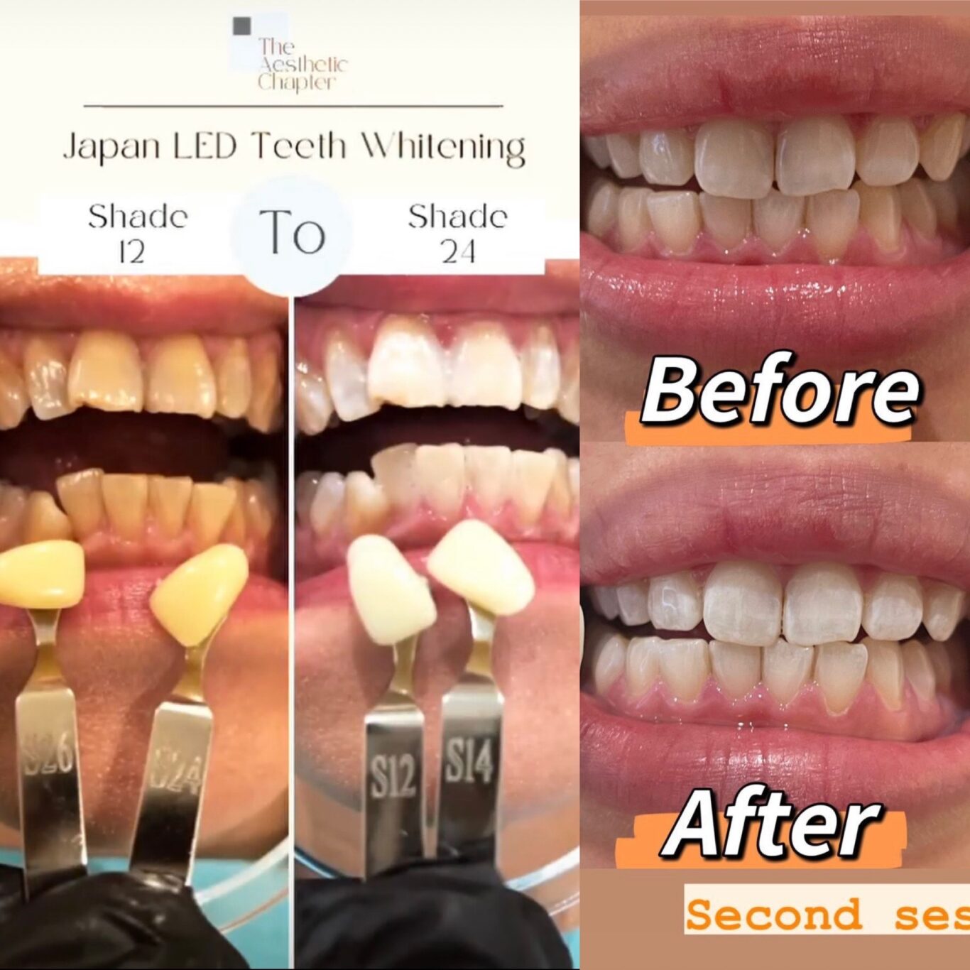 Japan Teeth Whitening (No1 Brand In Japan)
