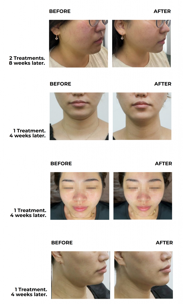 New Doublo HIFU | The Aesthetic Chapter Singapore